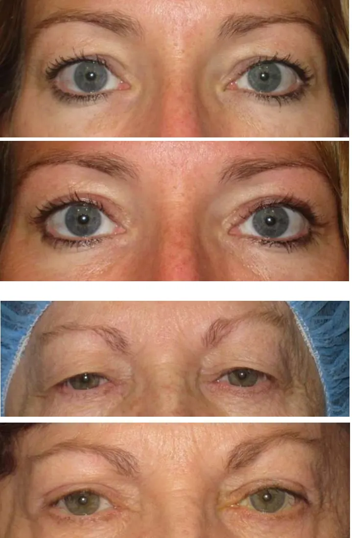 Upper eyelid blepharoplasty store